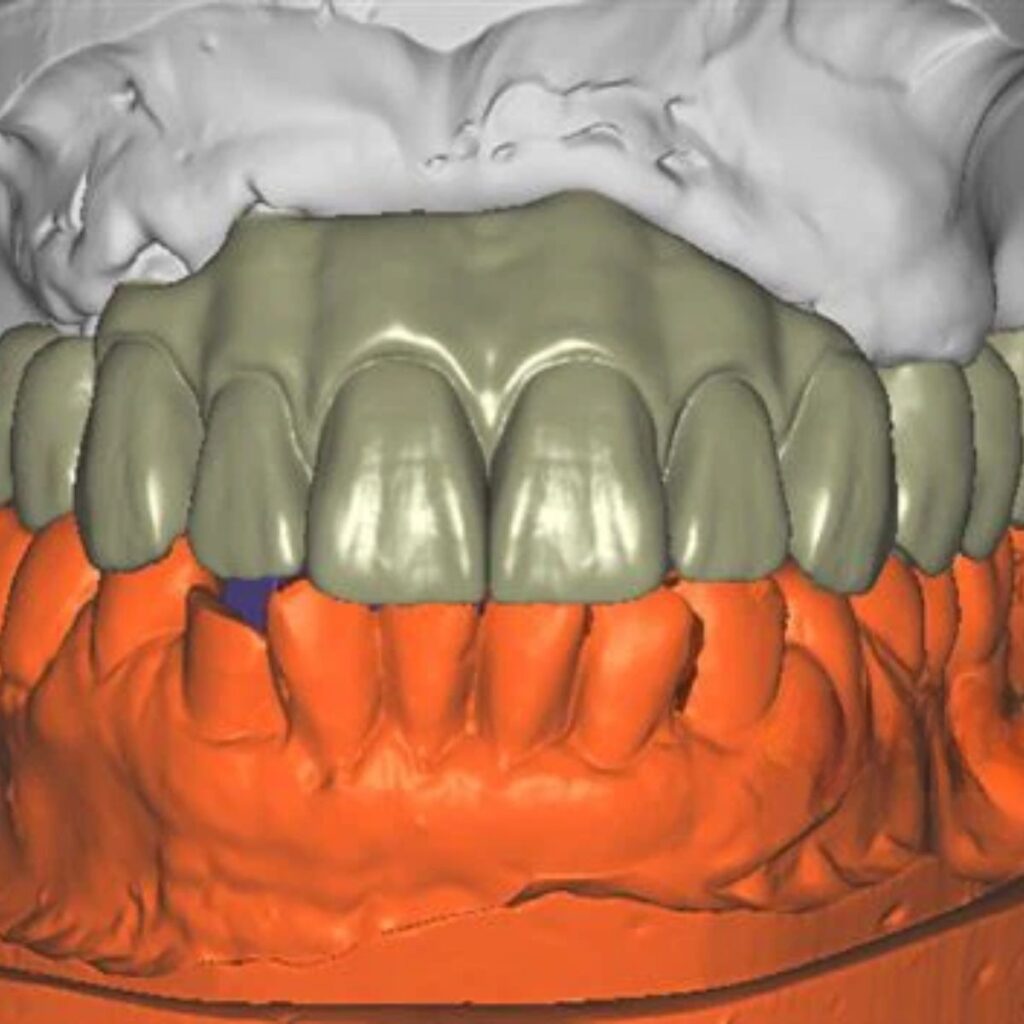 Full Anatomy Bridge Design Service | Zirconia & PMMA CAD (24h)